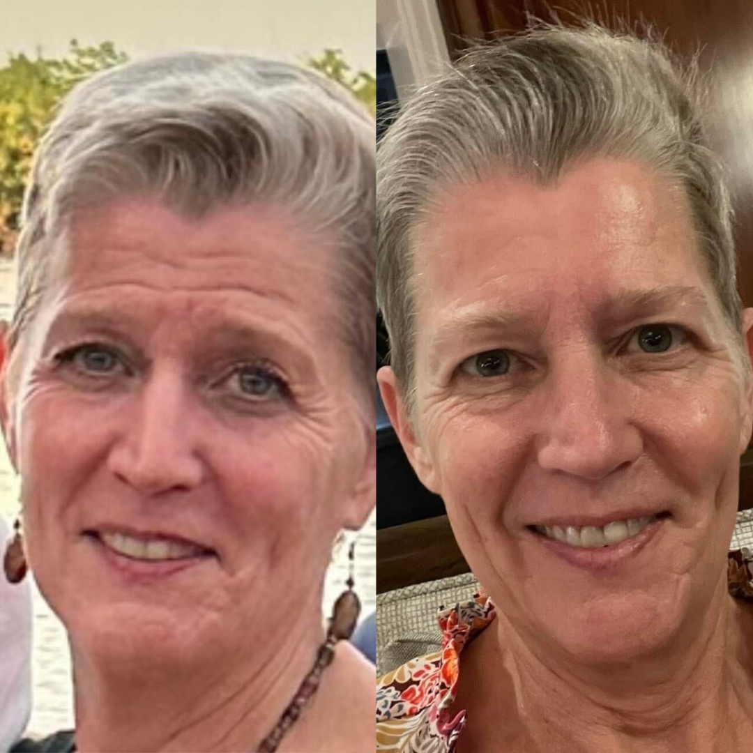 Frownies | The Original Wrinkle Patch