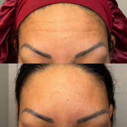 Forehead Wrinkle Patches | Forehead & Frown Line Solution